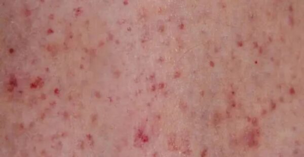 Red Dots on Skin: The Link Between Leukemia and Petechiae - Kevin ...